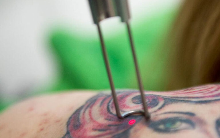 Laser Tattoo Removal - Erase Unwanted Ink